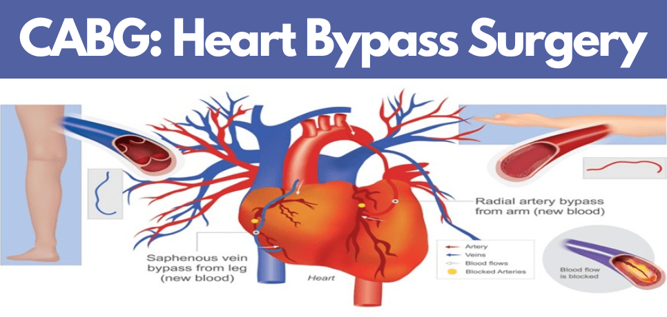 Coronary Artery Bypass Grafting: Indications, Procedure, and Recovery