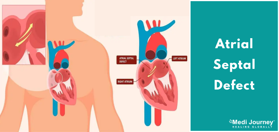 Atrial Septal Defect Explained: Causes, Symptoms, and Treatment Insights