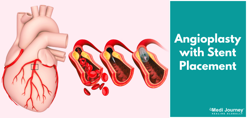 Angioplasty with Stent Placement: How it Helps Open Blocked Arteries